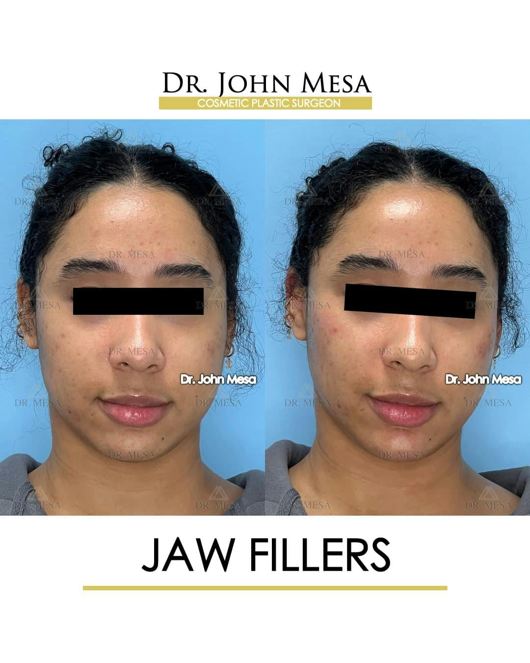 Jaw Filler Before & After Photos | Dr. Mesa