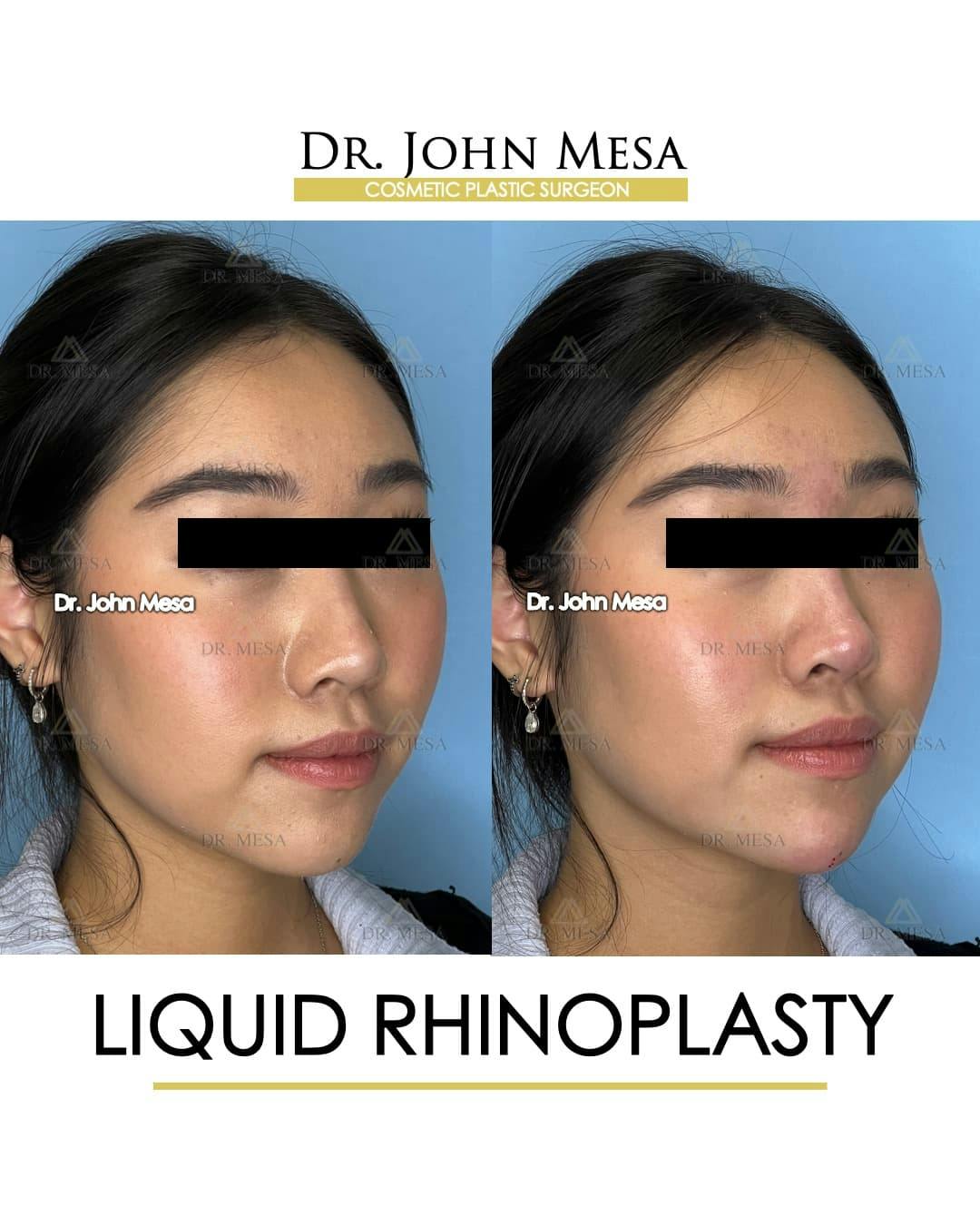 Liquid Rhinoplasty Before & After Photos | Dr. Mesa