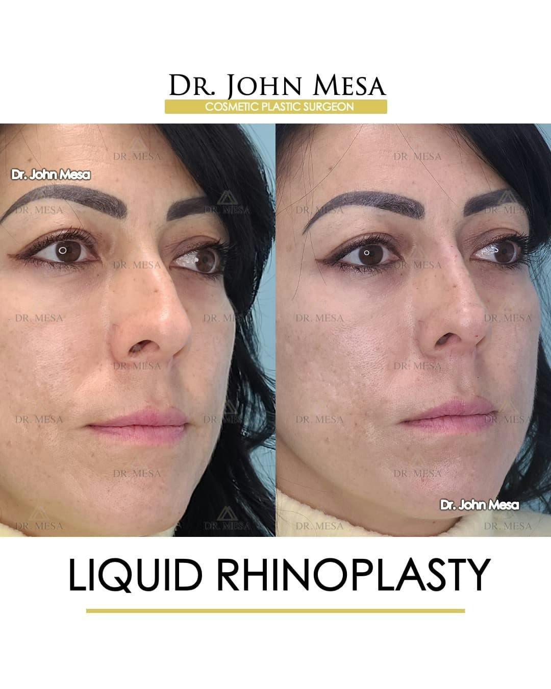 Liquid Rhinoplasty Before & After Photos | Dr. Mesa