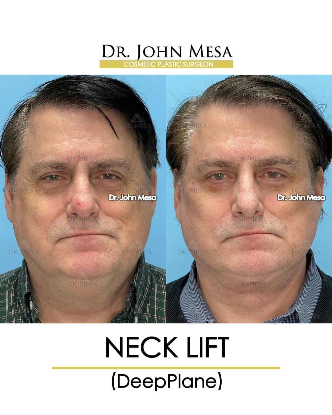 Neck Lift for Men Before & After Photos | Dr. Mesa