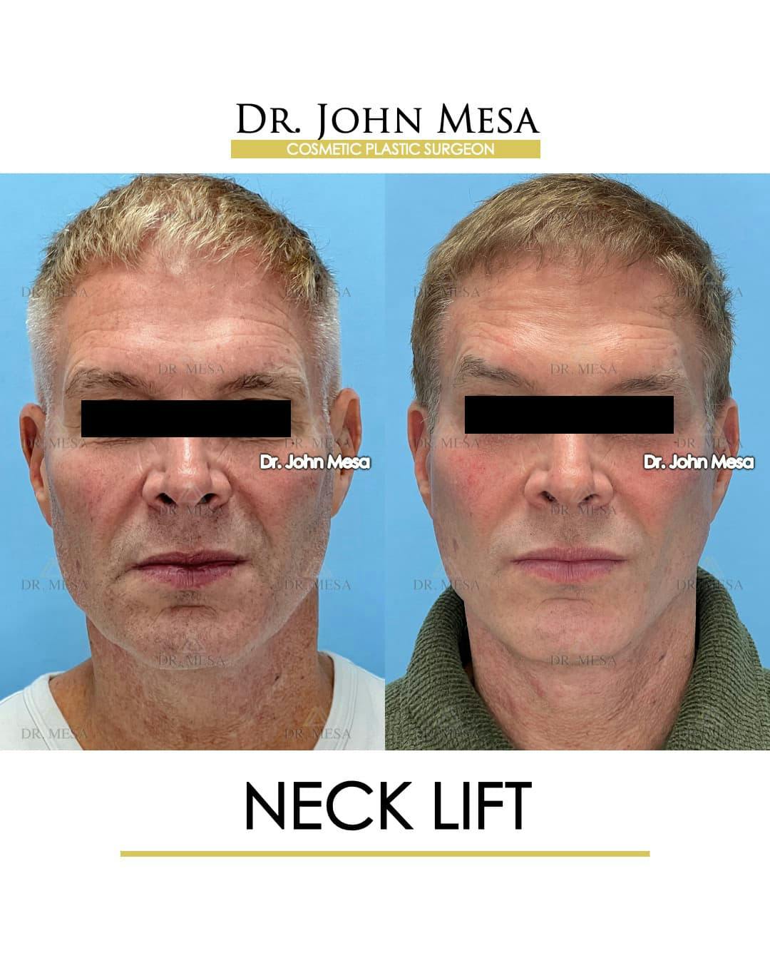 Neck Lift for Men Before & After Photos | Dr. Mesa