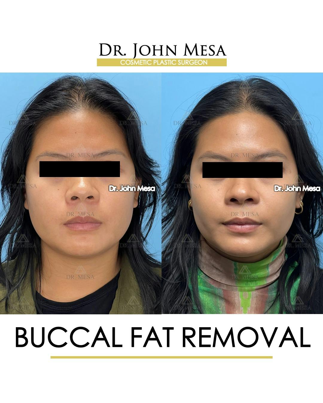 Buccal Fat Pad Removal Before & After Photos | Dr. Mesa