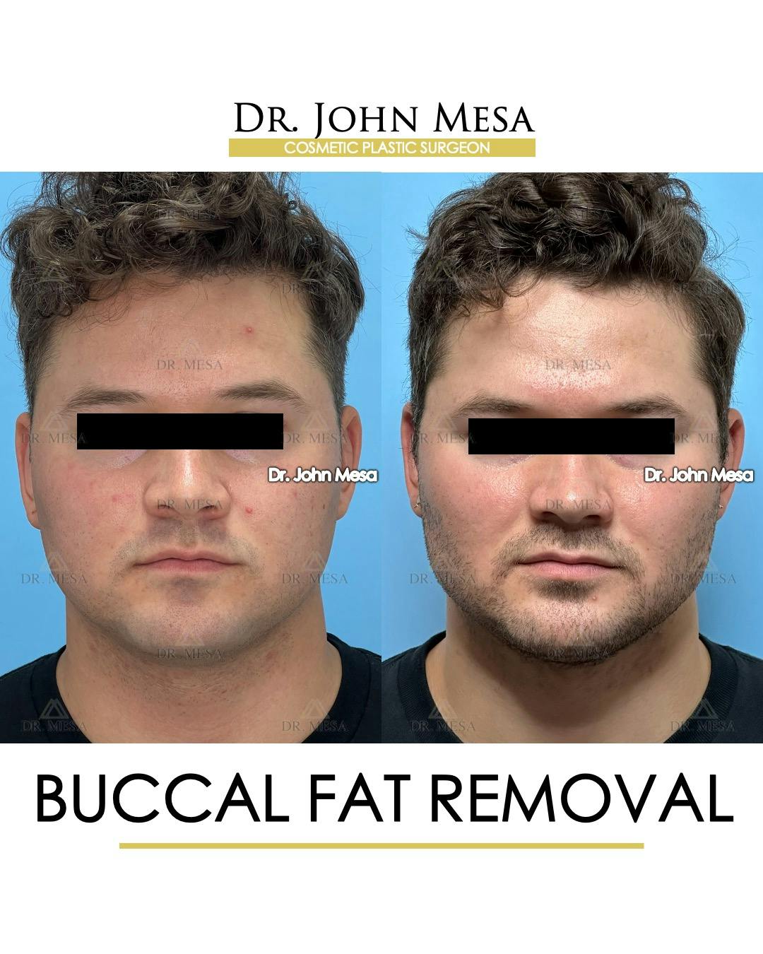 Buccal Fat Pad Removal for Men Before & After Photos | Dr. Mesa