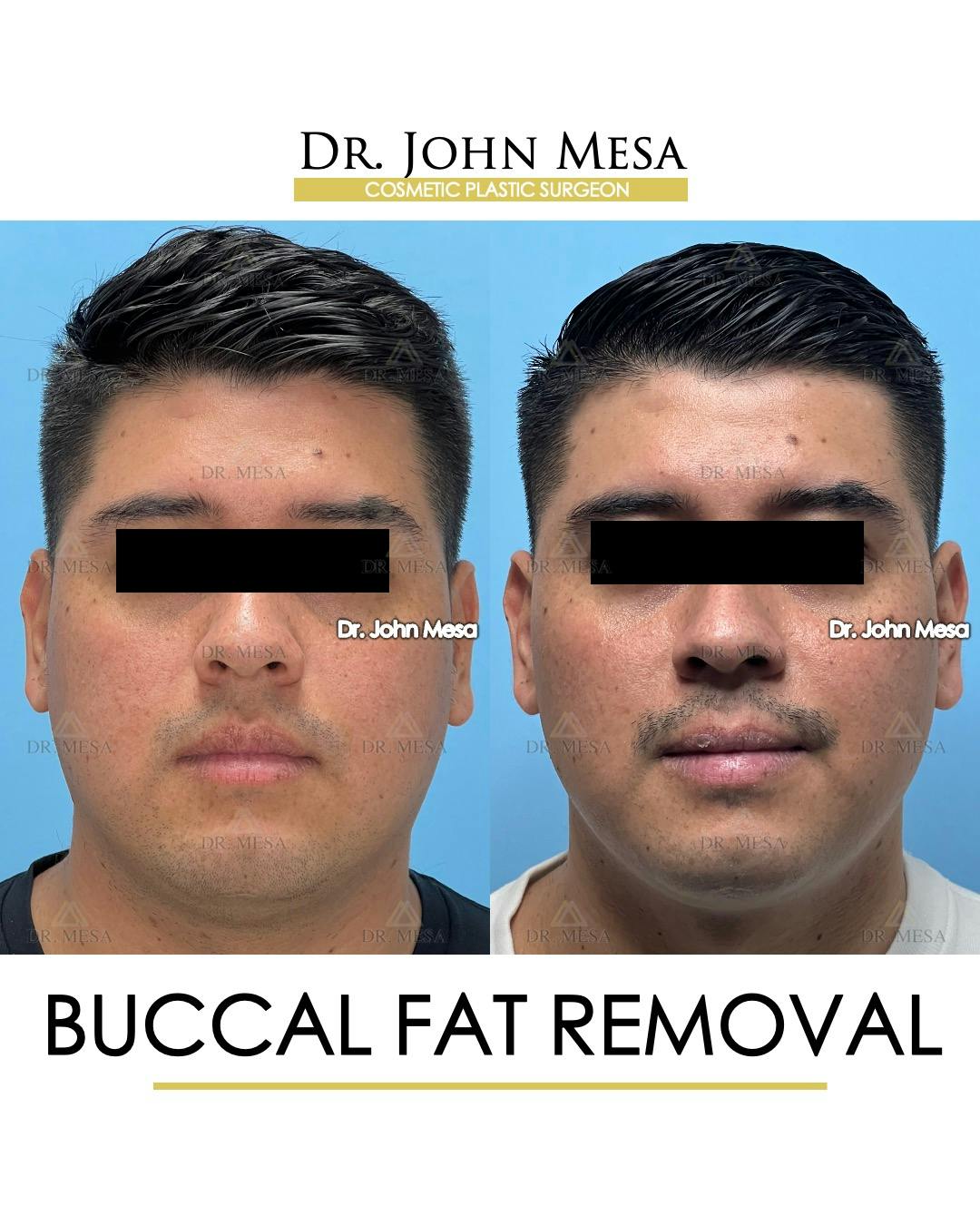 Buccal Fat Pad Removal for Men Before & After Photos | Dr. Mesa