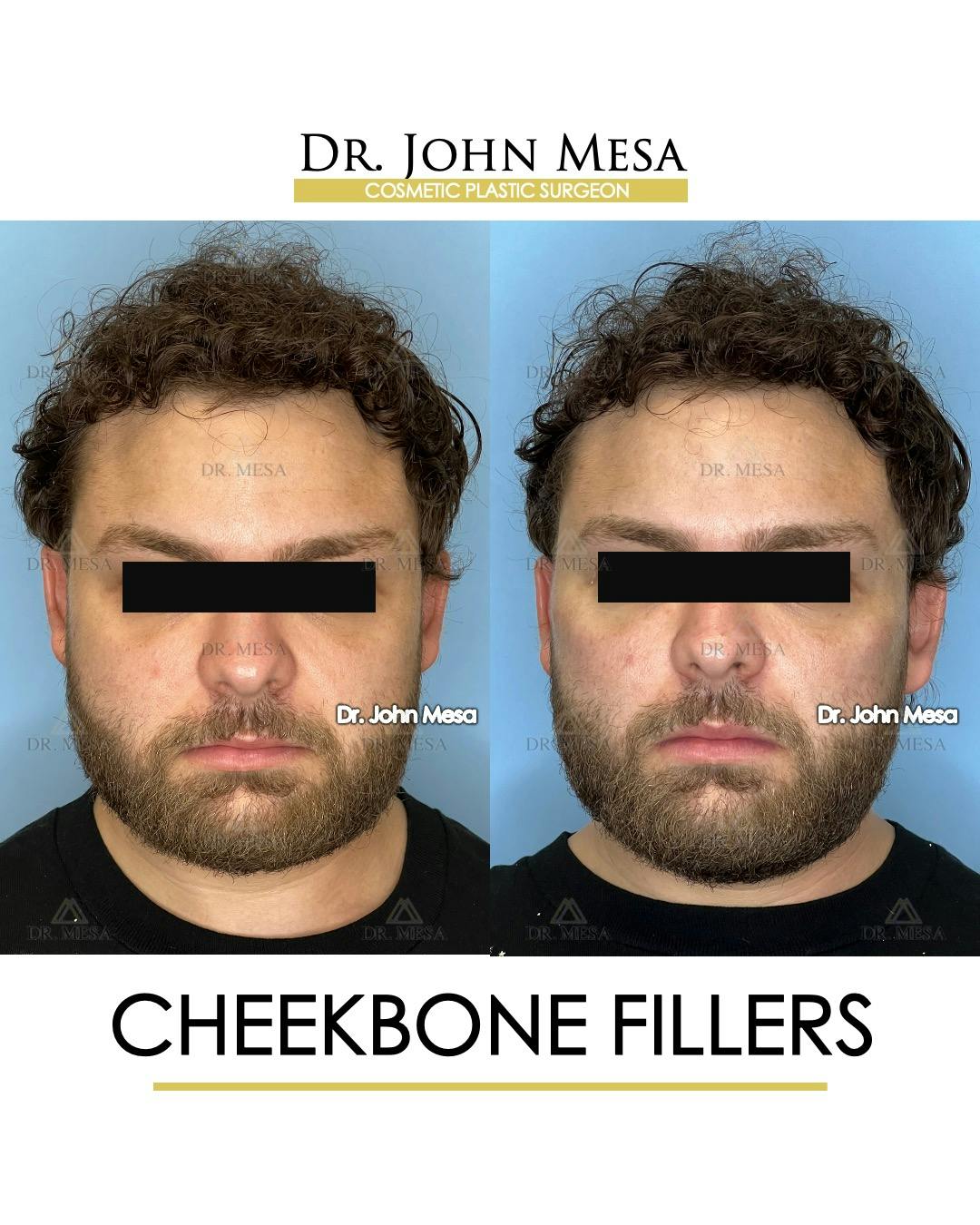 Cheekbone Filler for Men Before & After Photos | Dr. Mesa