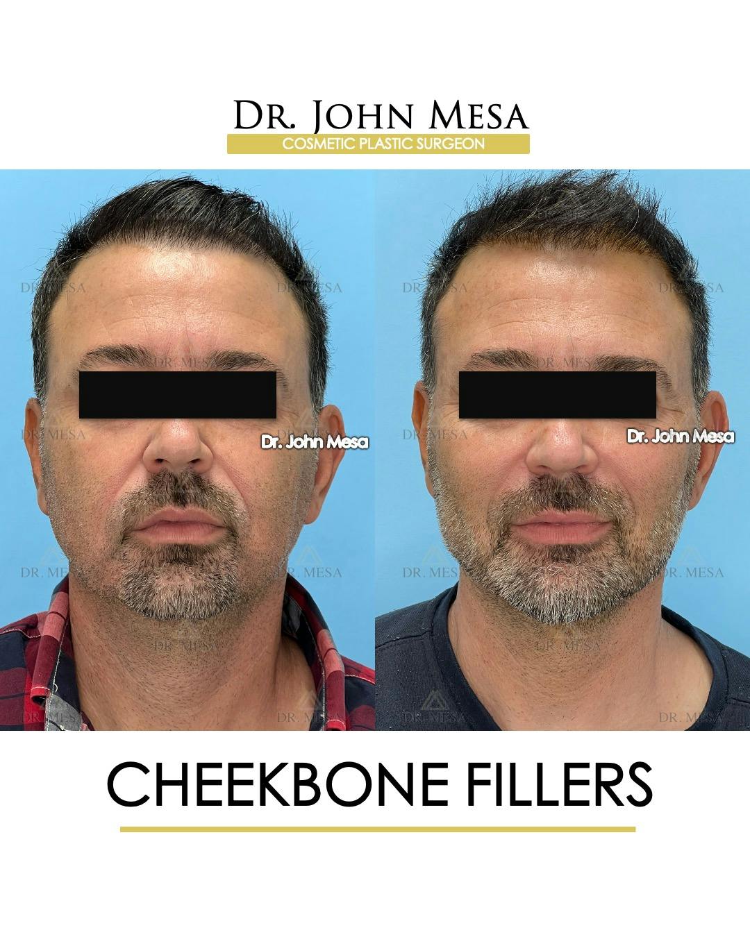 Cheekbone Filler for Men Before & After Photos | Dr. Mesa