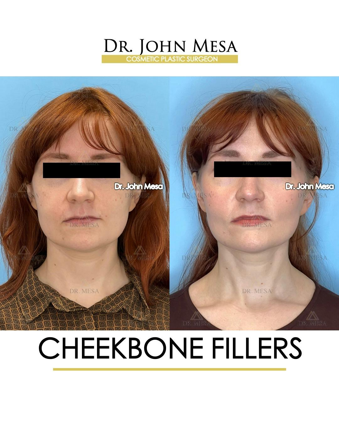 Cheekbone Filler Before & After Photos | Dr. Mesa