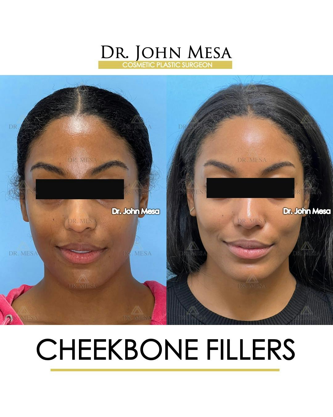 Cheekbone Filler Before & After Photos | Dr. Mesa