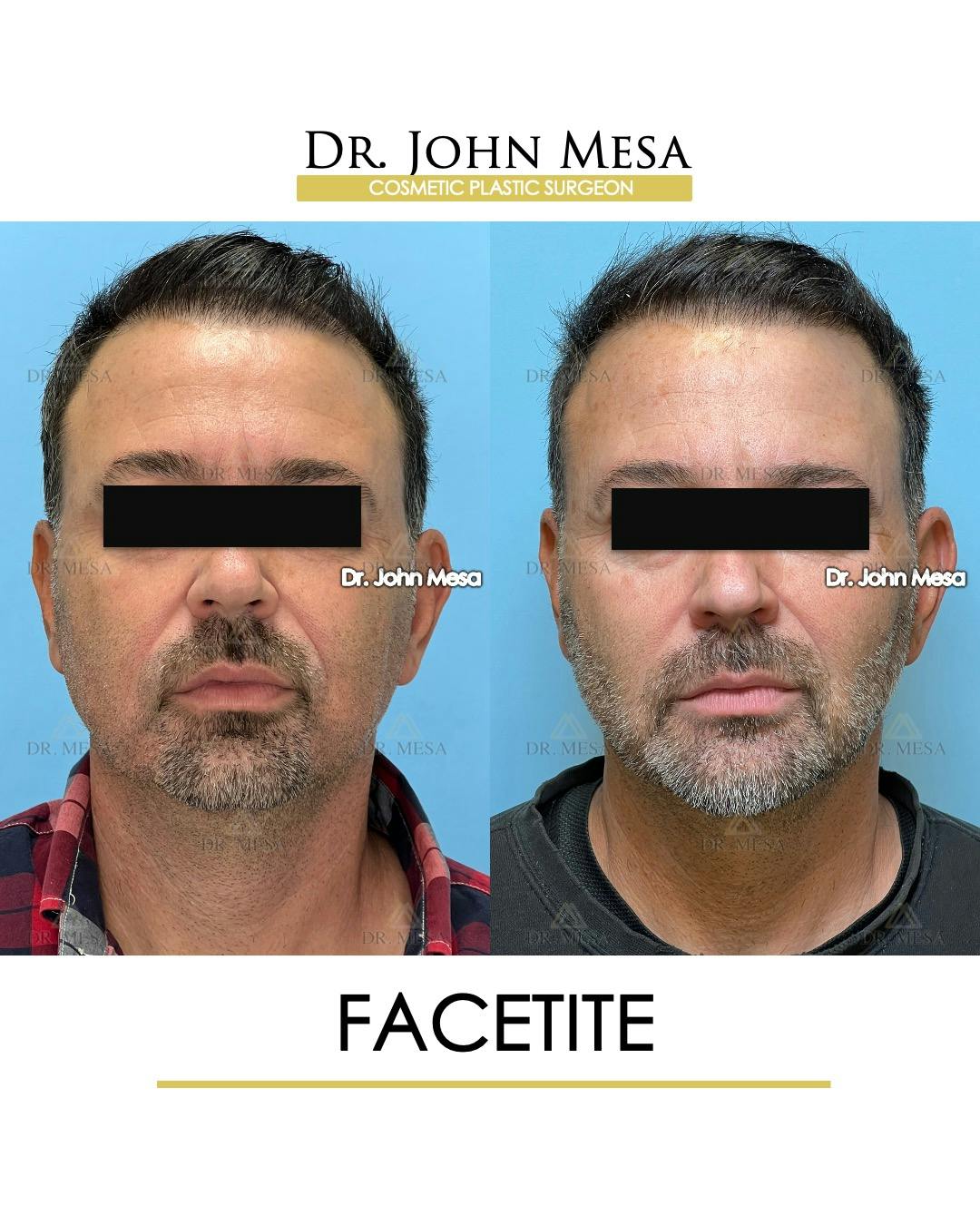 FaceTite for Men Before & After Photos | Dr. Mesa