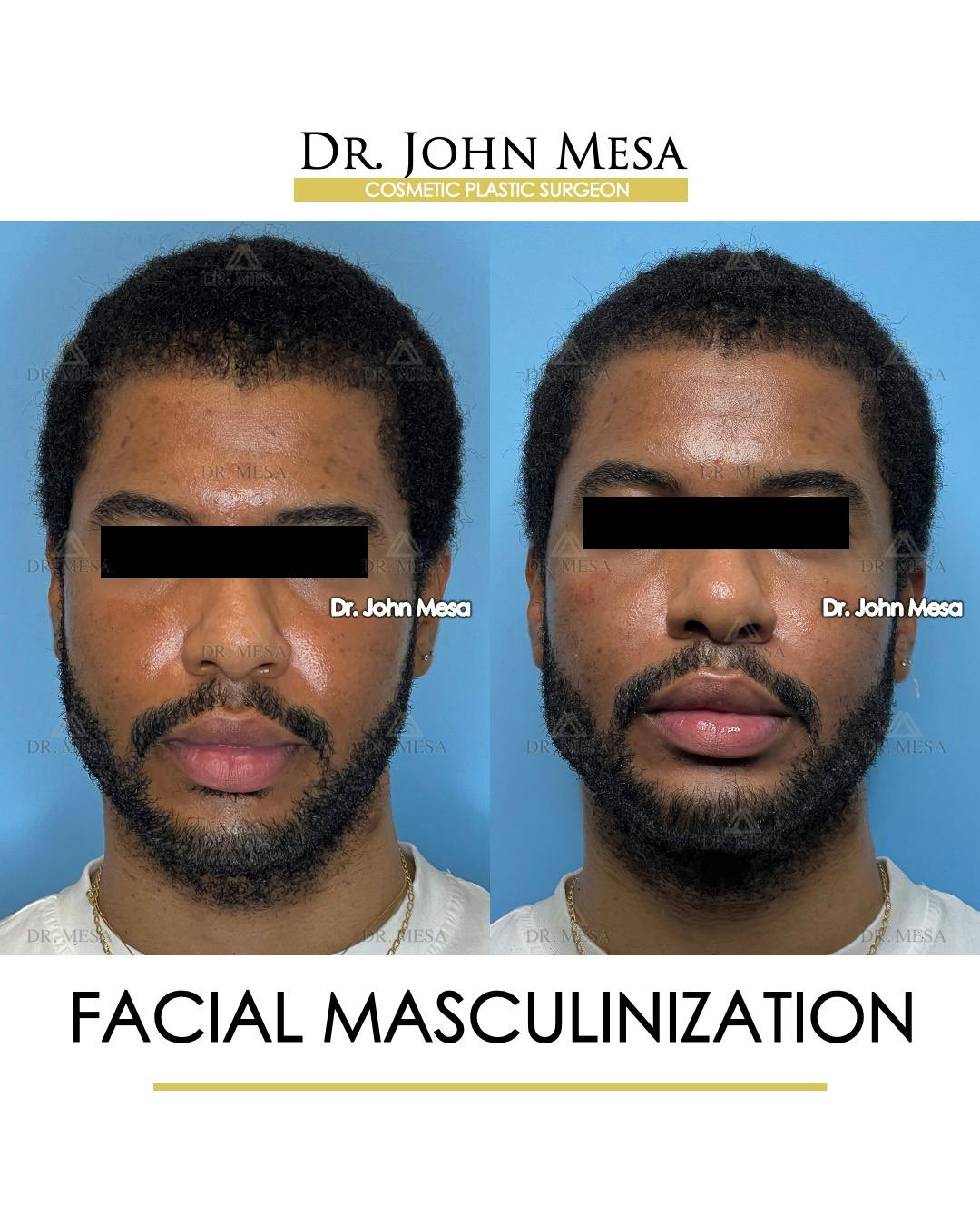 Facial Masculinization Before & After Photos | Dr. Mesa