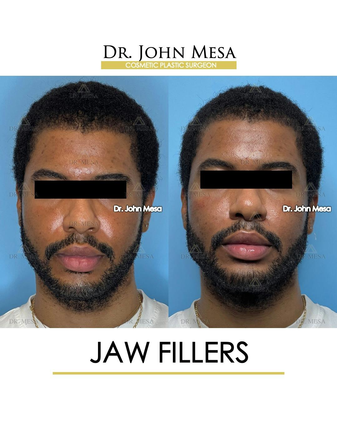 Jaw Filler for Men Before & After Photos | Dr. Mesa