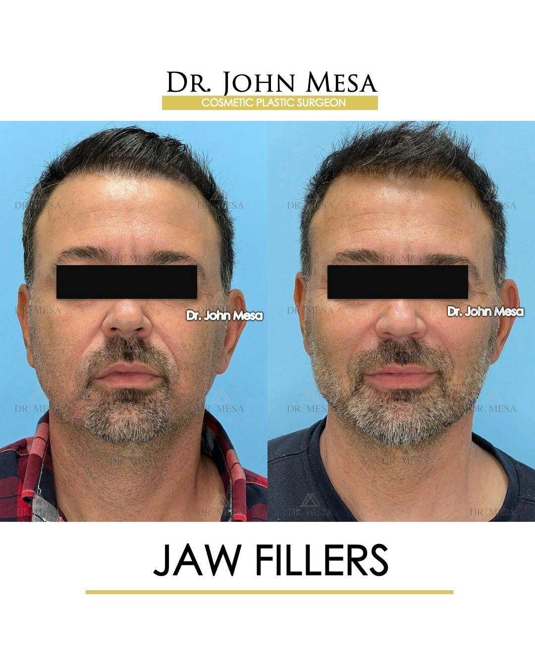 Jaw Filler for Men Before & After Photos | Dr. Mesa