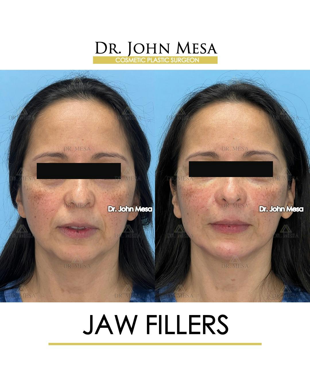 Jaw Filler Before & After Photos | Dr. Mesa