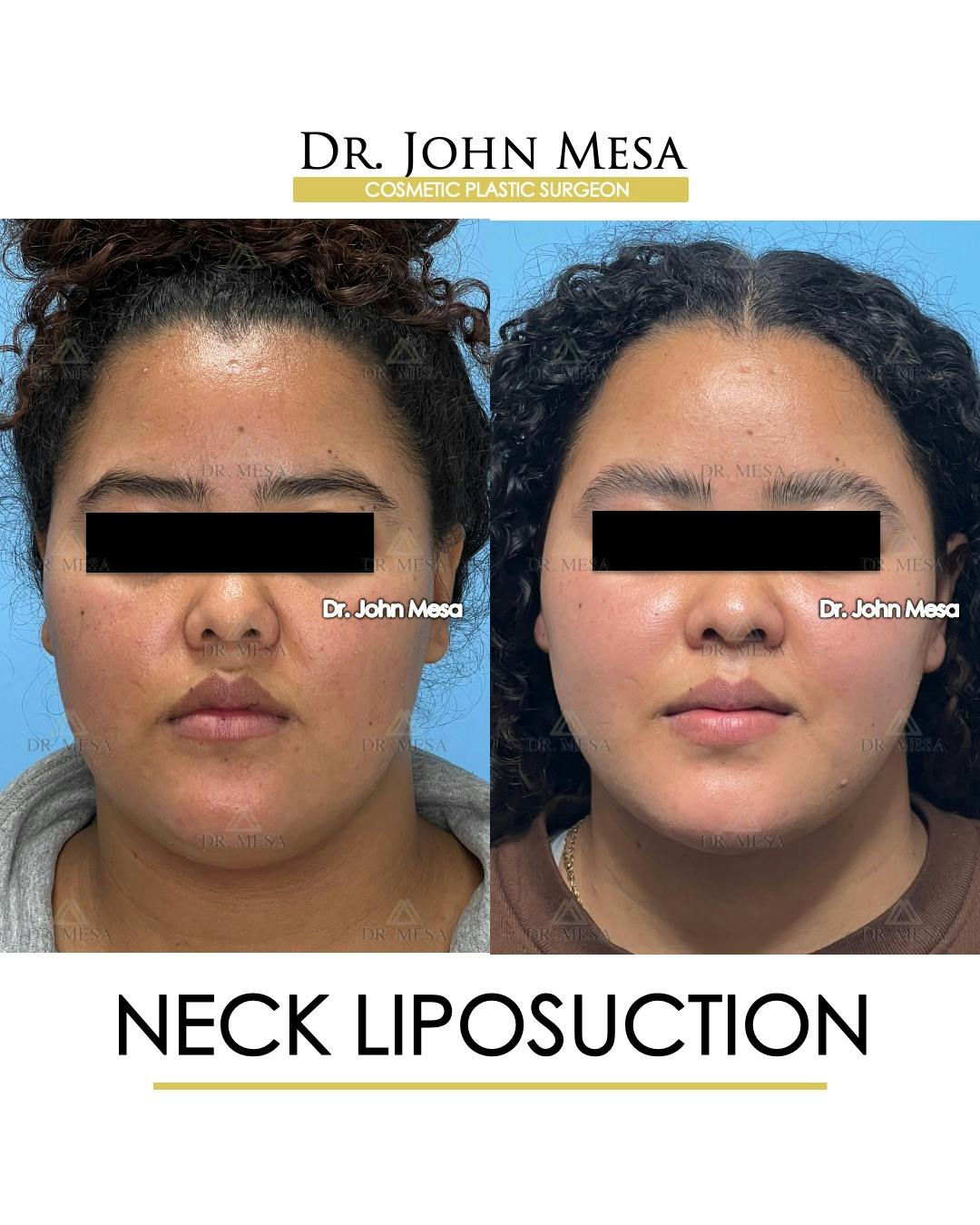 Neck Liposuction Before & After Photos | Dr. Mesa
