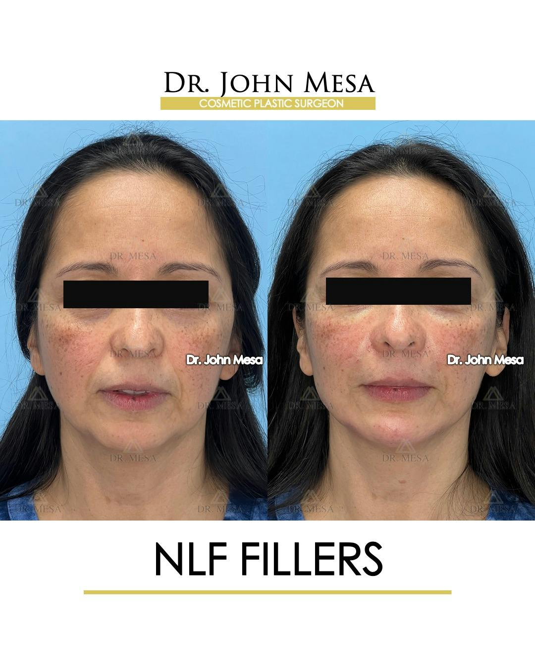 NLF Fillers Before & After Photos | Dr. Mesa