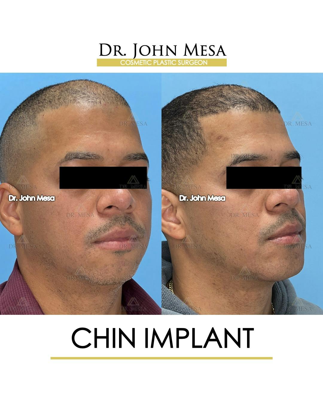 Chin Implant Before & After Photos | Dr. Mesa