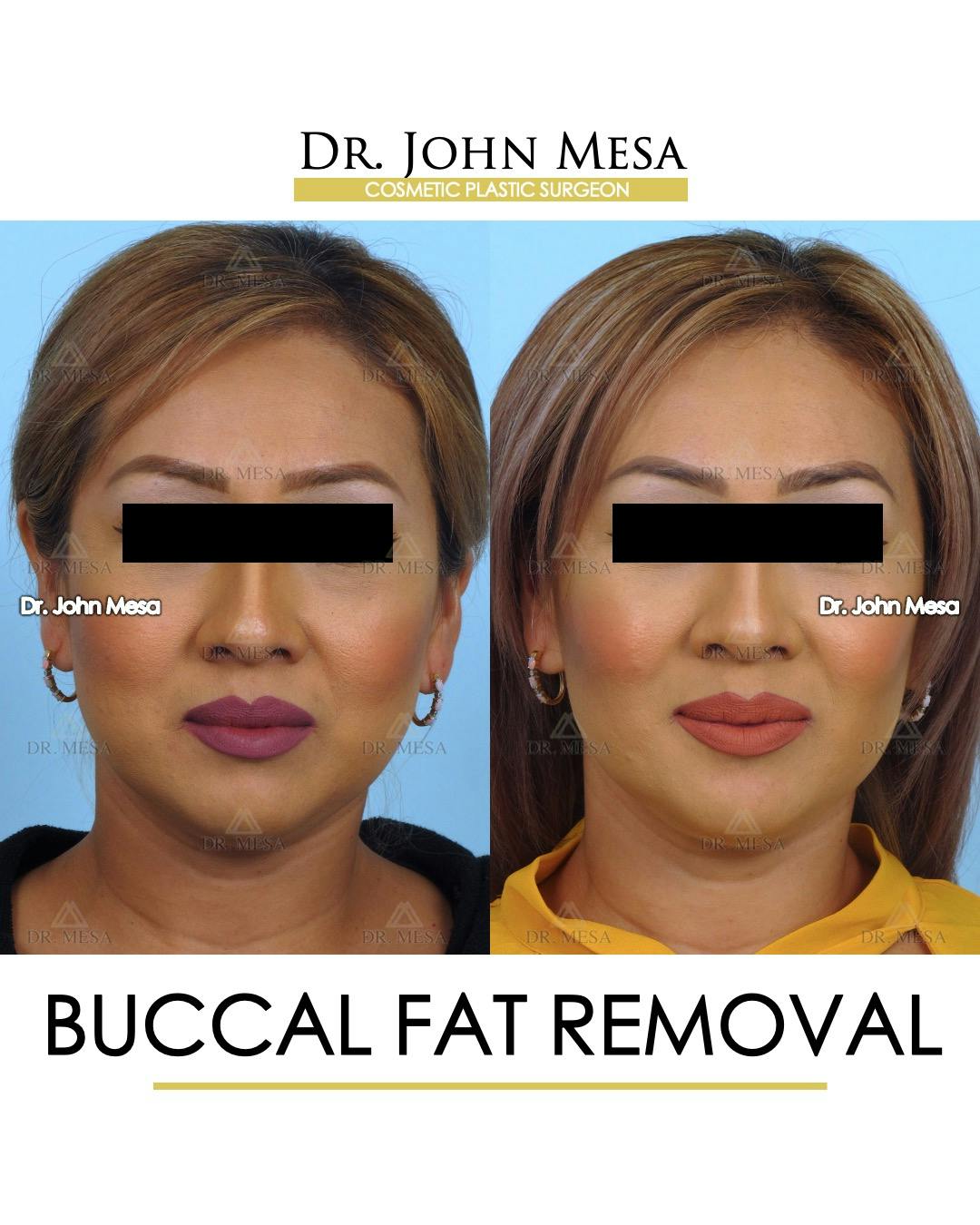 Buccal Fat Pad Removal Before & After Photos | Dr. Mesa