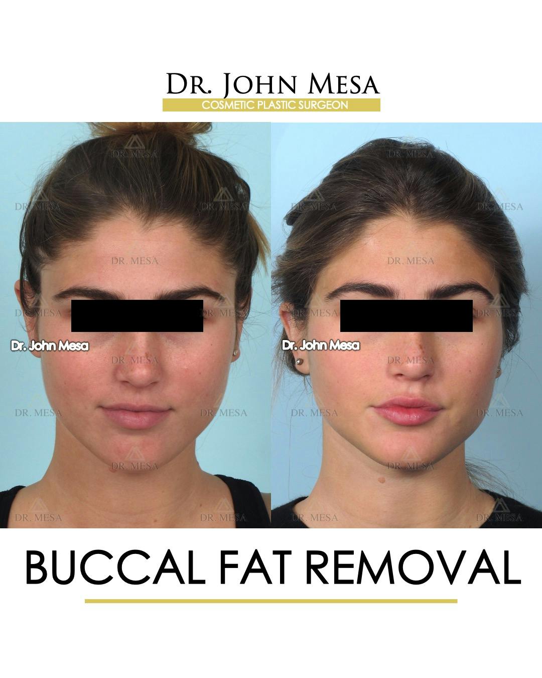 Buccal Fat Pad Removal Before & After Photos | Dr. Mesa
