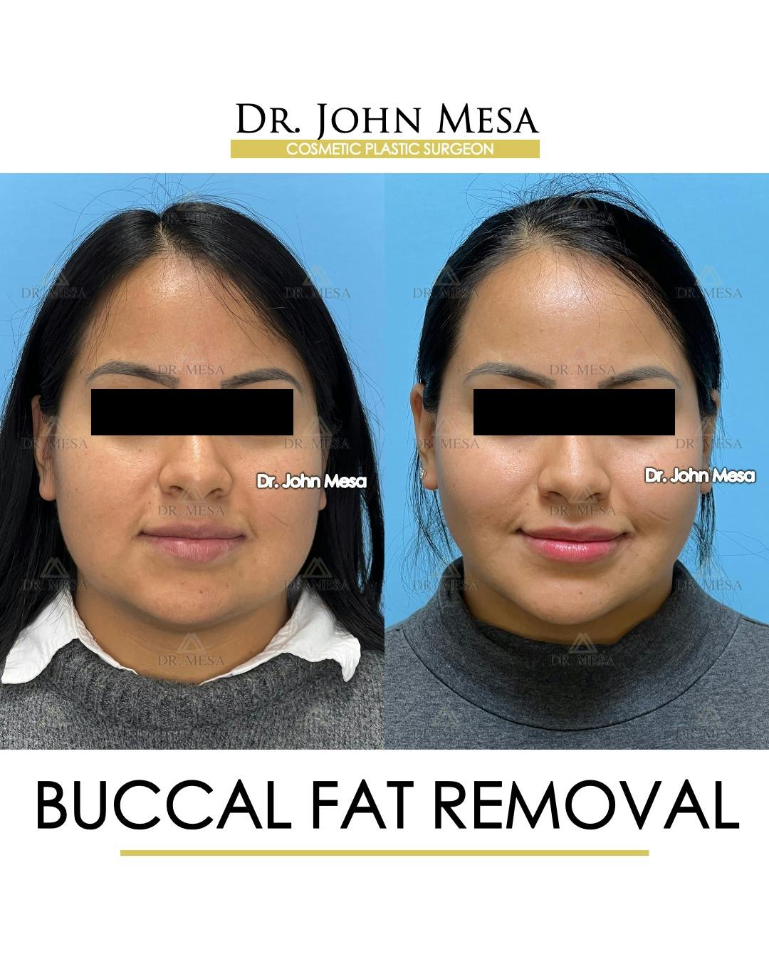 Buccal Fat Pad Removal Before & After Photos | Dr. Mesa