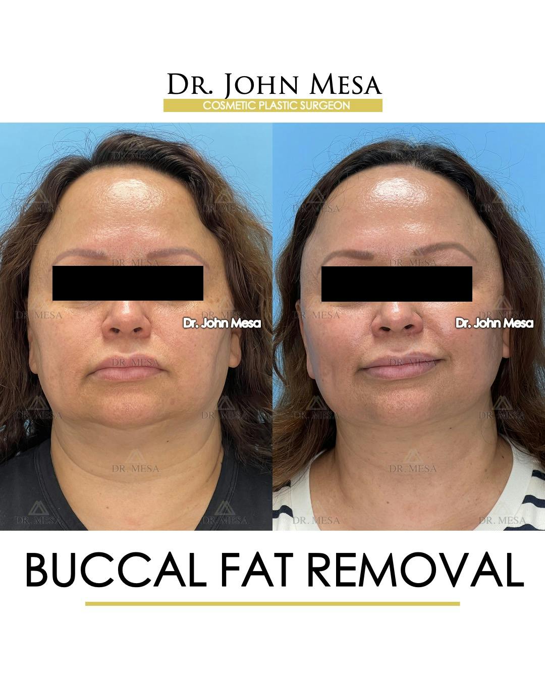 Buccal Fat Pad Removal Before & After Photos | Dr. Mesa