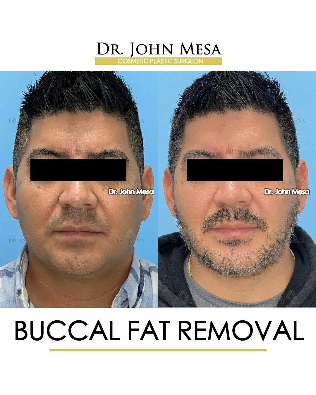 Buccal Fat Pad Removal for Men Before & After Photos | Dr. Mesa
