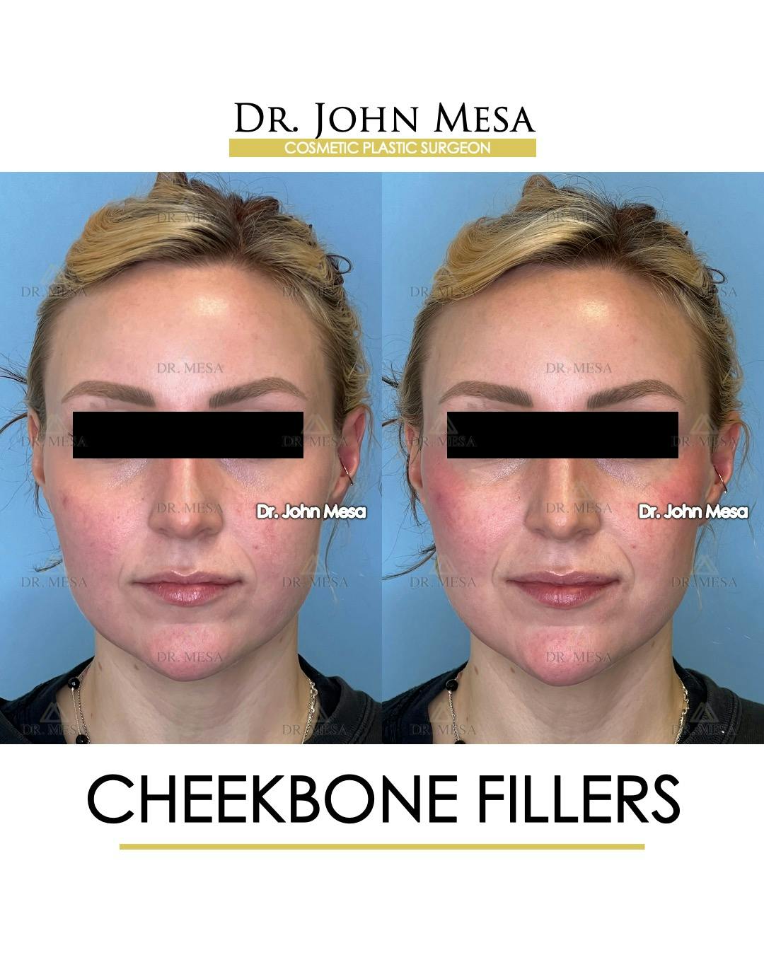 Cheekbone Filler Before & After Photos | Dr. Mesa