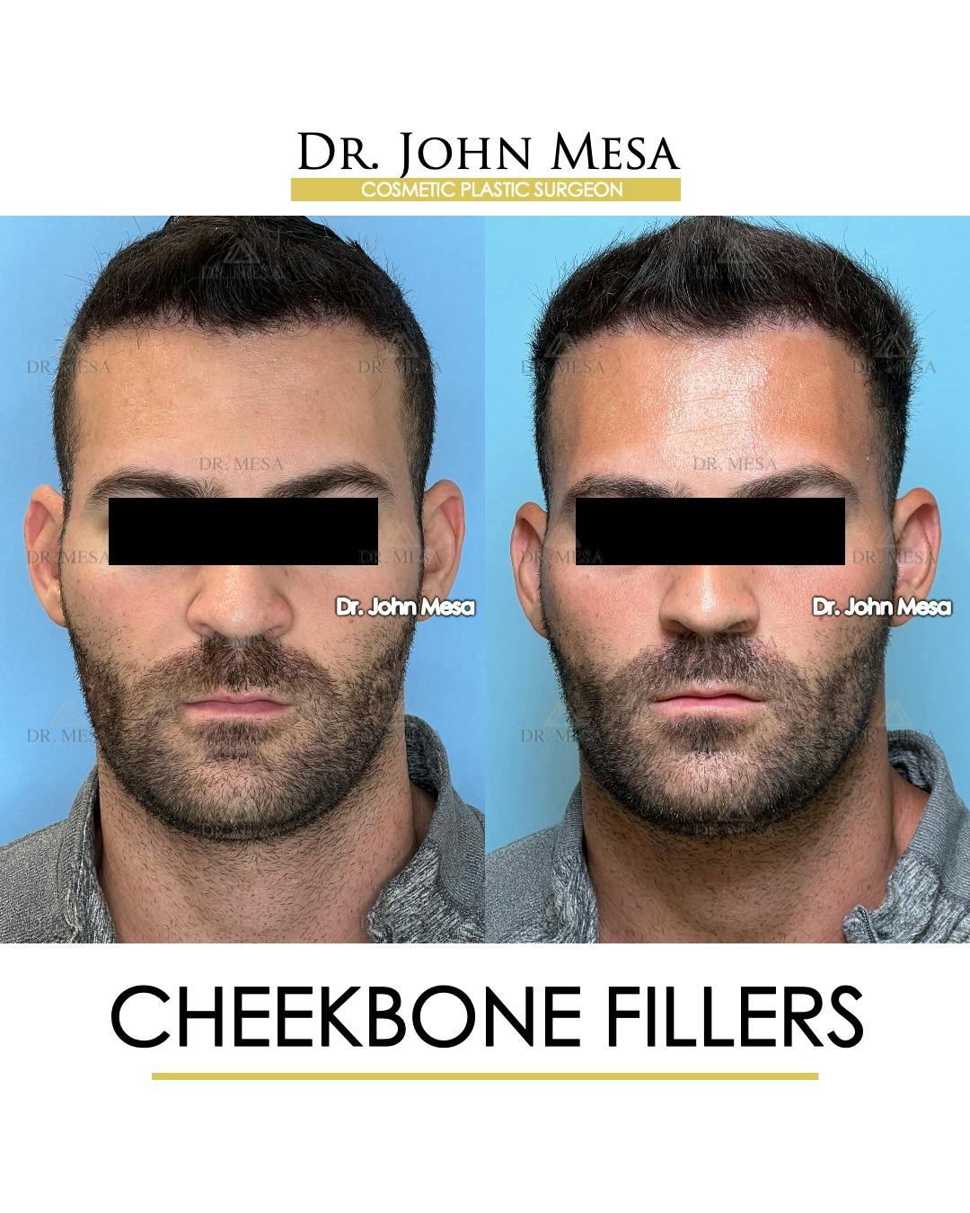 Cheekbone Filler for Men Before & After Photos | Dr. Mesa