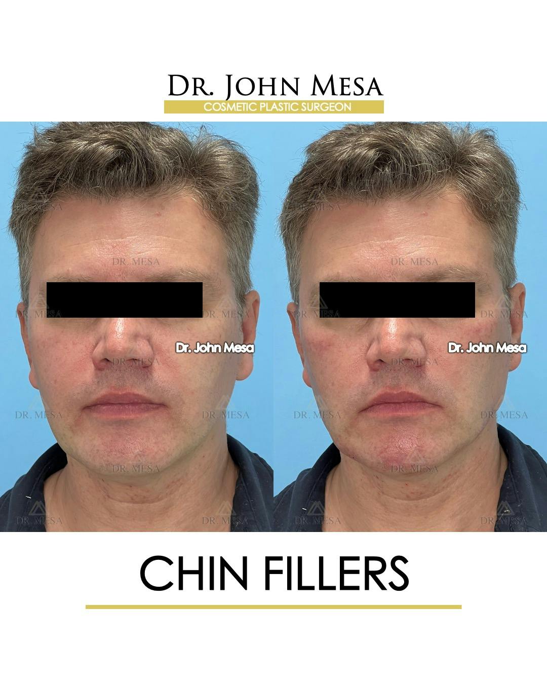 Chin Filler for Men Before & After Photos | Dr. Mesa