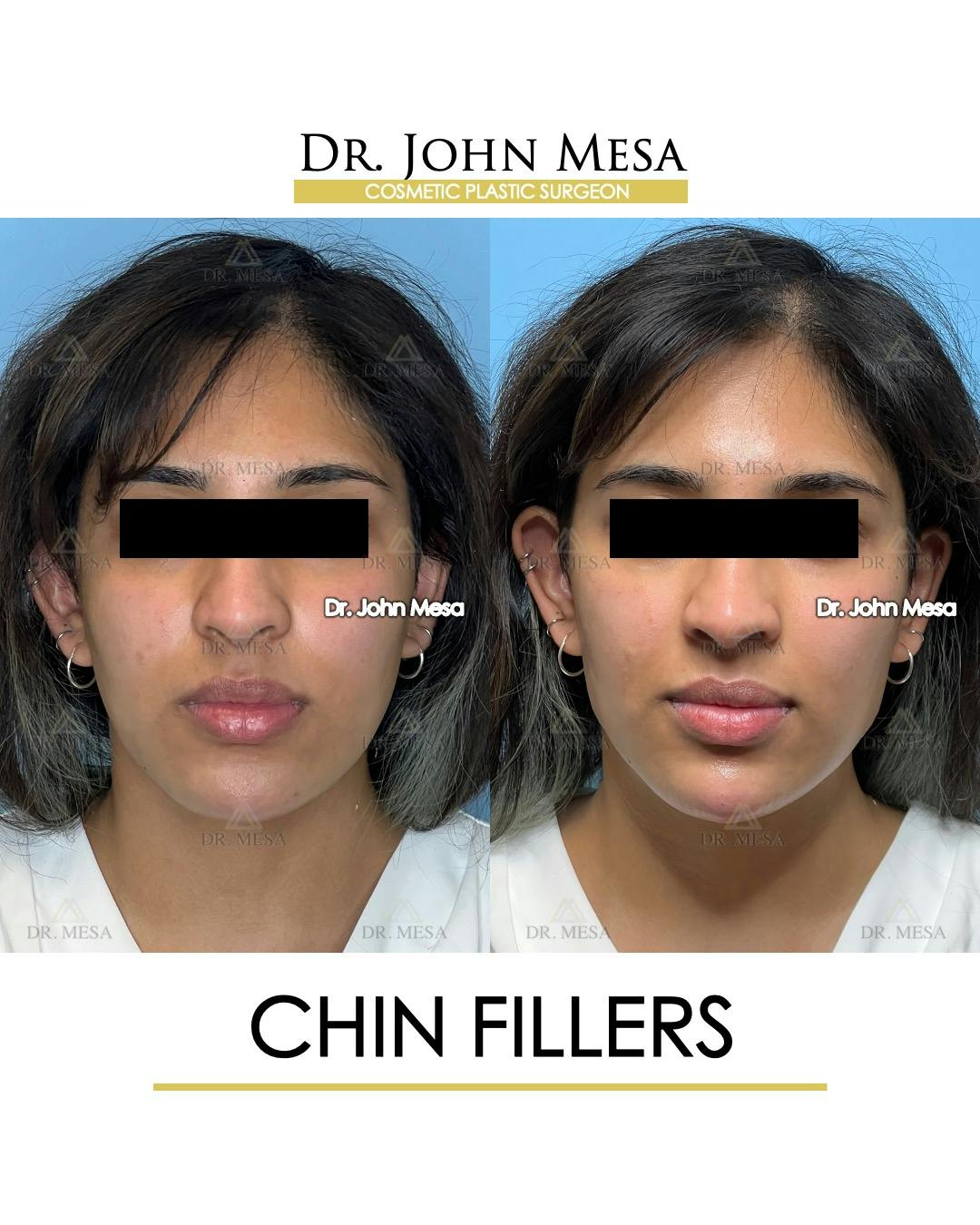 Chin Filler Before & After Photos | Dr. Mesa