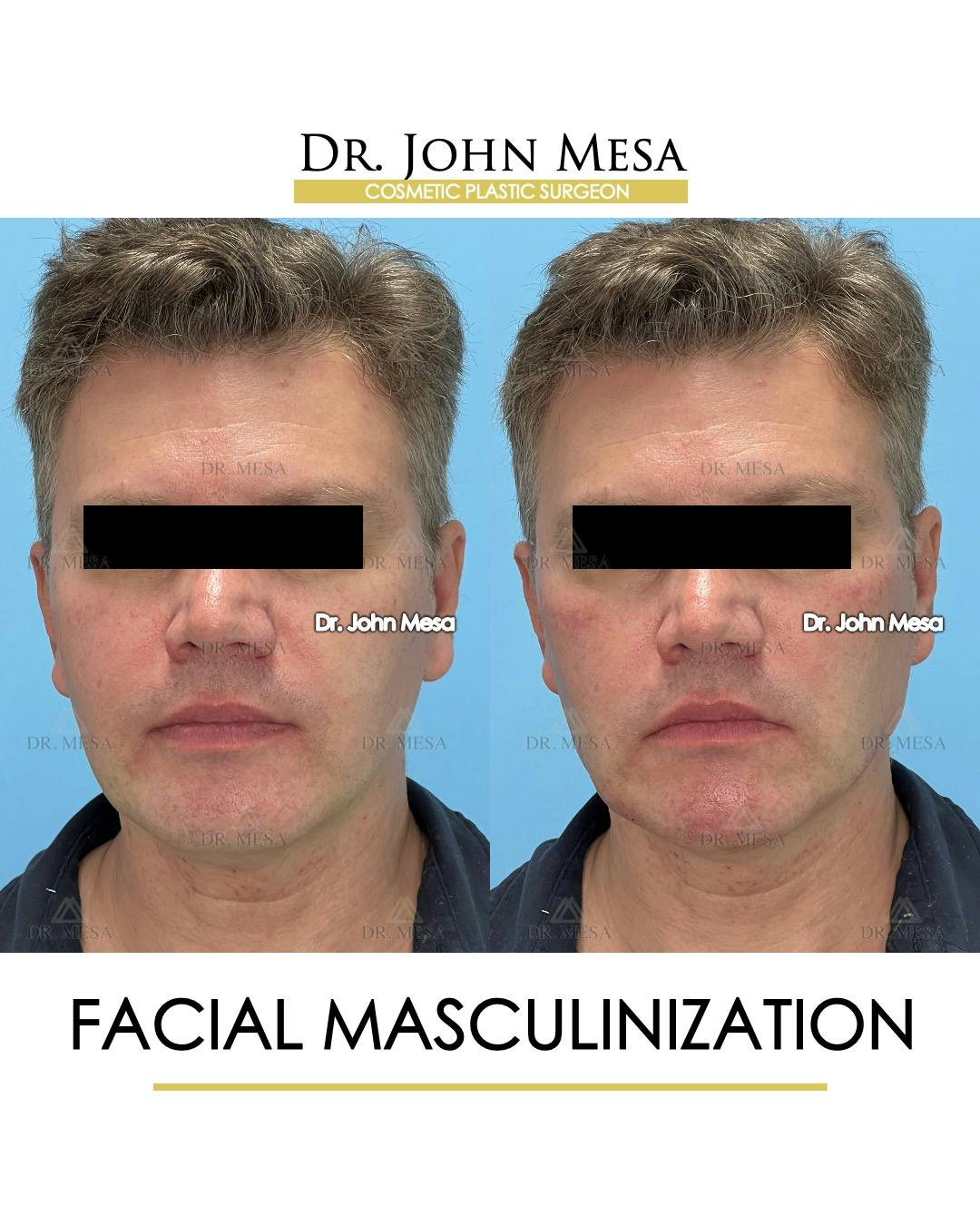 Facial Masculinization Before & After Photos | Dr. Mesa