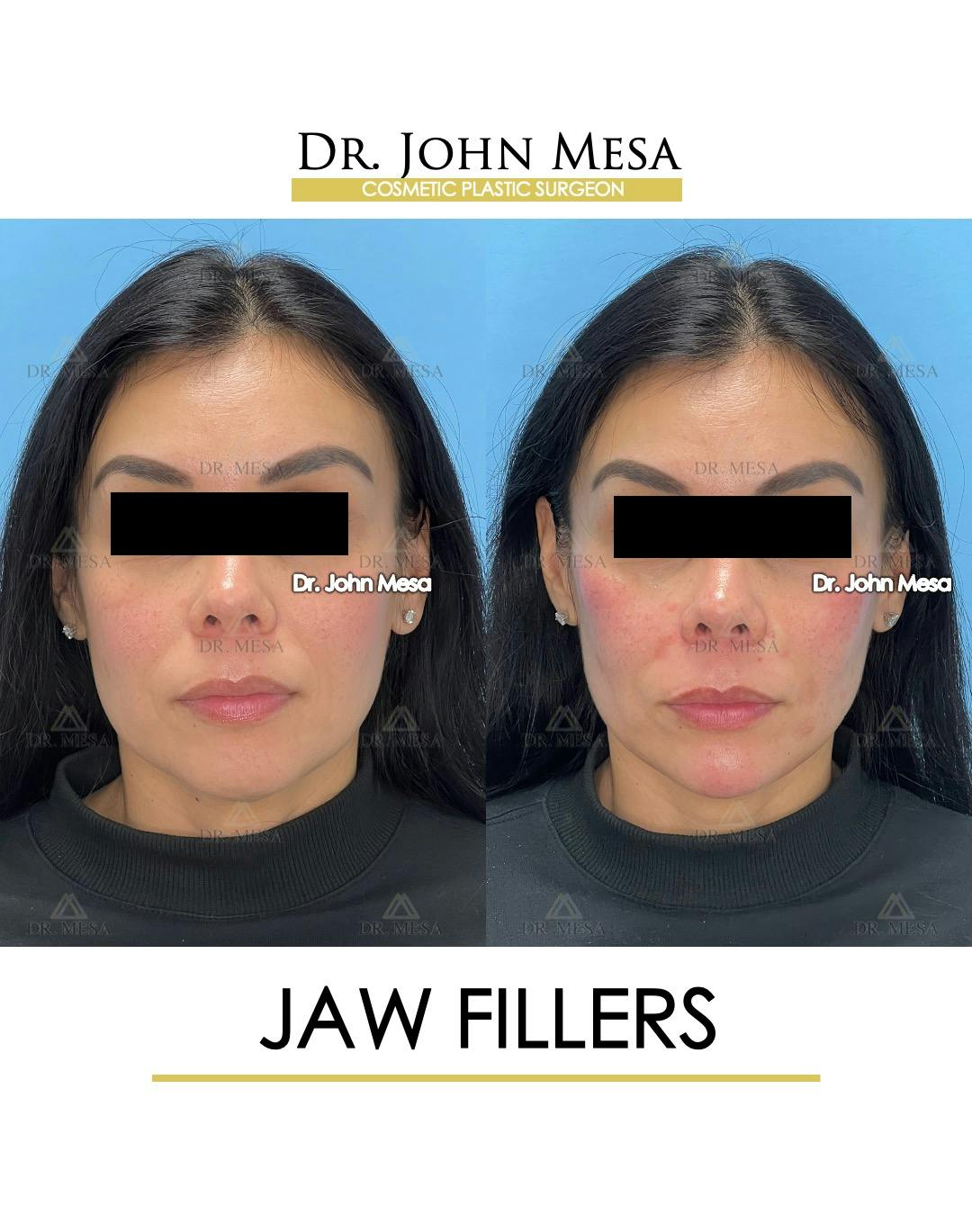 Jaw Filler Before & After Photos | Dr. Mesa