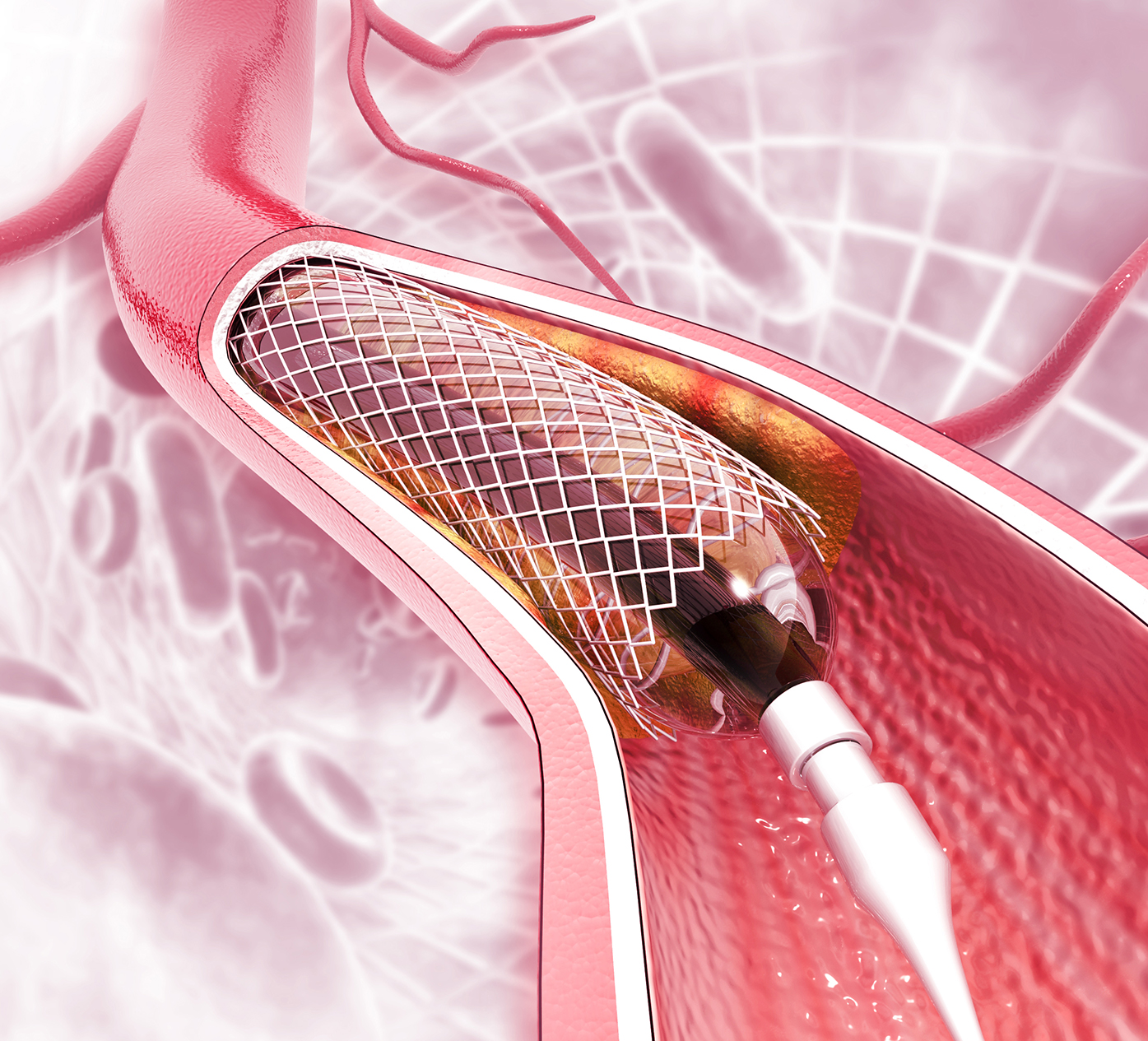 MindFrameCapture LP Revascularization Injury Lawyer Chicago