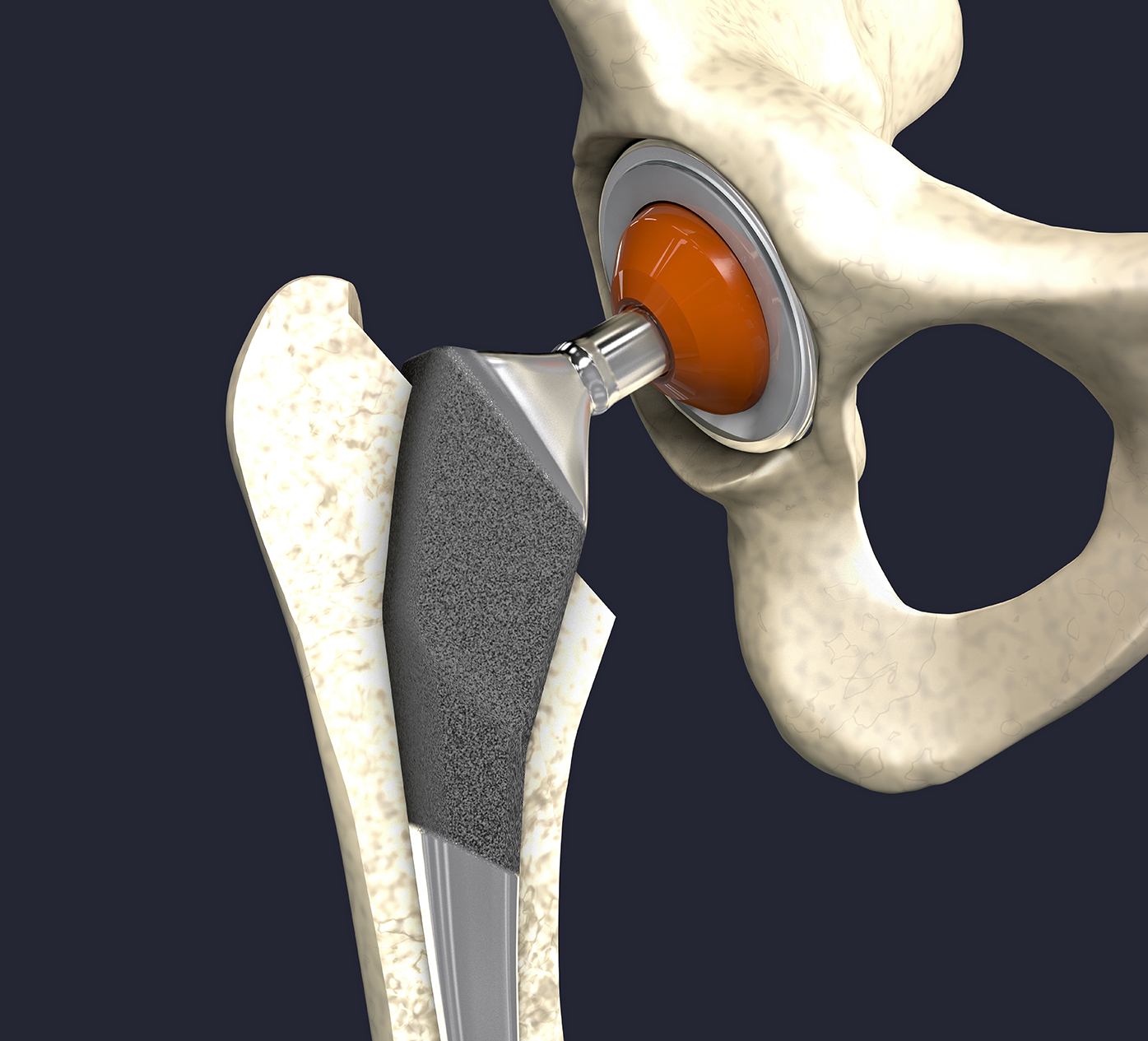 Profemur Hip Recall | Meyers & Flowers