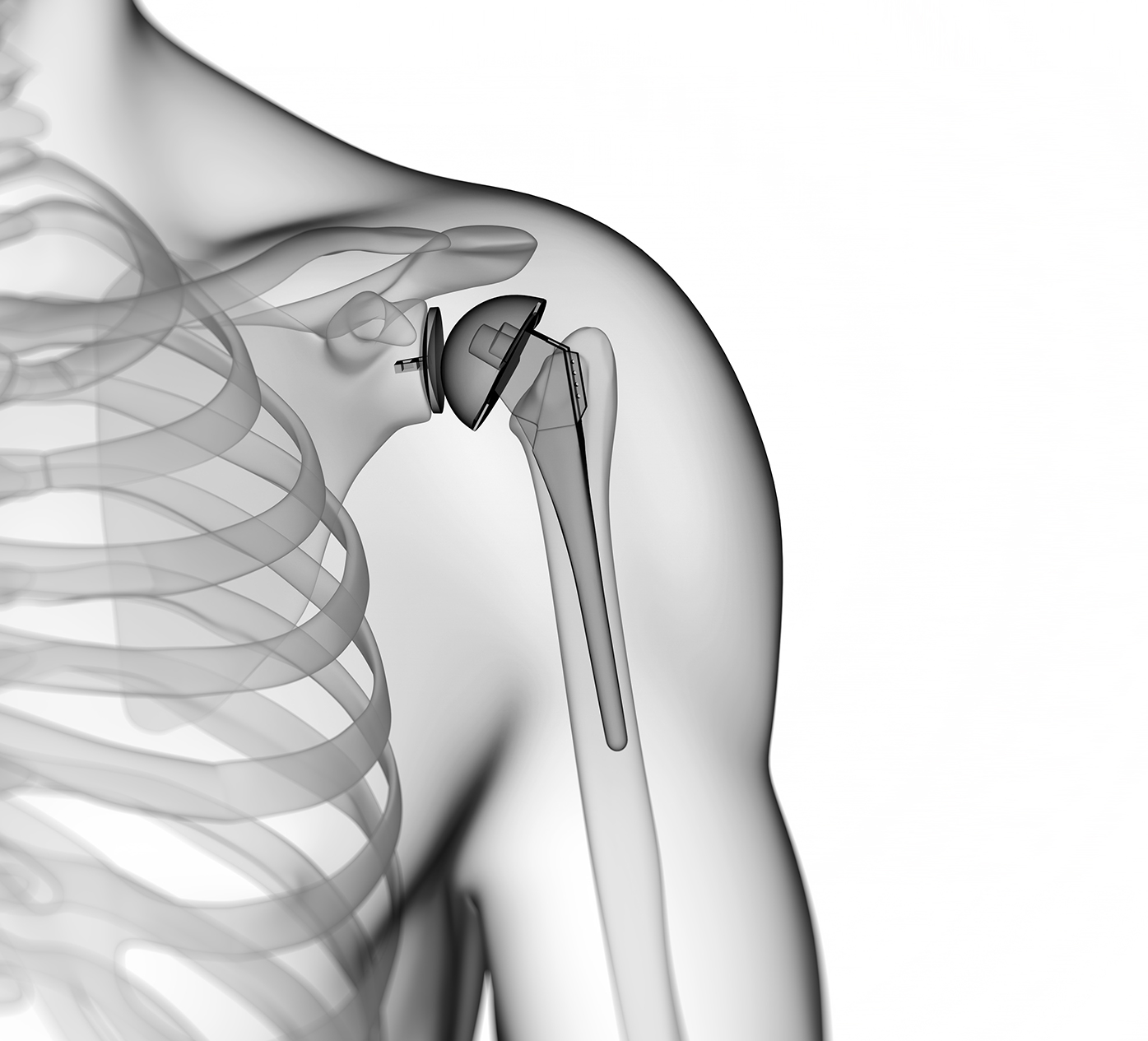 Zimmer Comprehensive Reverse Shoulder Recall Lawyers