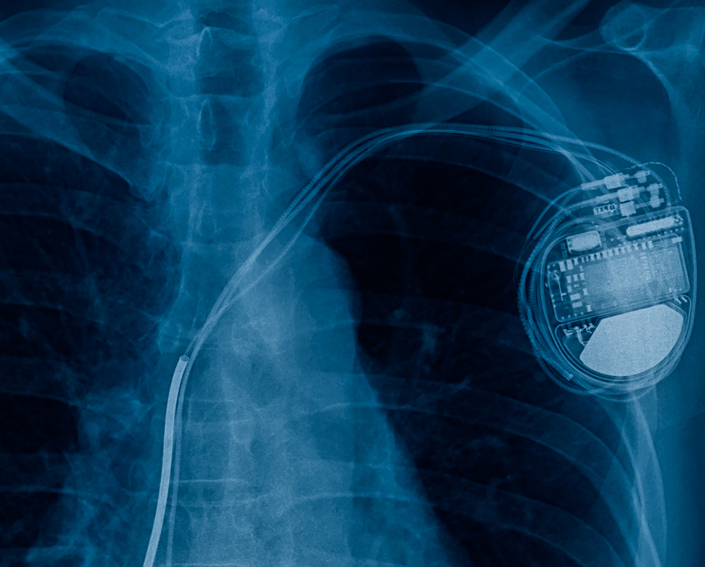 Medtronic Cardiac Recall | Meyers & Flowers