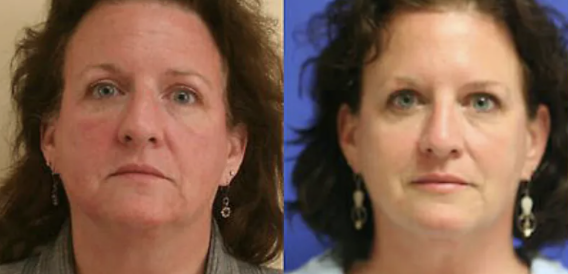 Ultherapy New Jersey | Skin Tightening Princeton, NJ