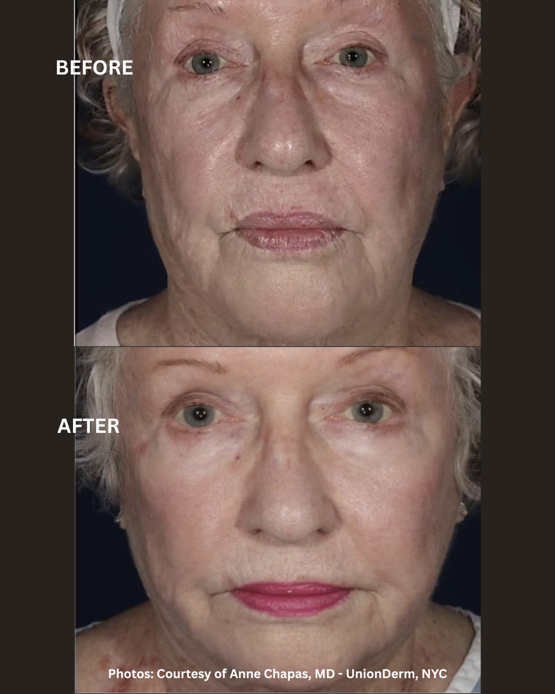 AVAVA Laser Treatment New Jersey | Hazen Plastic Surgery