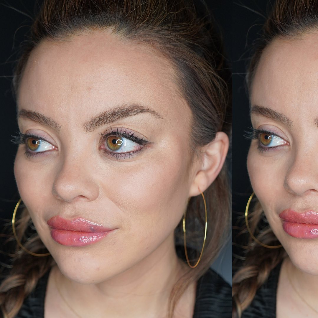 Sculptra Houstin, TX | Dr. Courtney