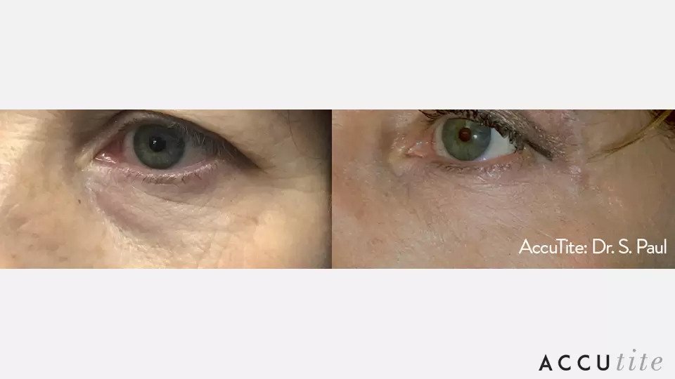 AccuTite Kirkland | AccuTite Treatment in Auburn, WA