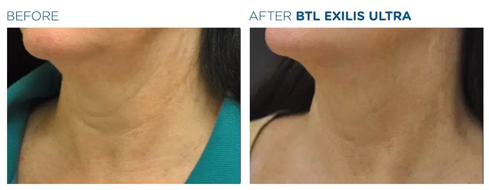 Exilis Ultra Kirkland | Exilis Ultra Treatment in Auburn, WA