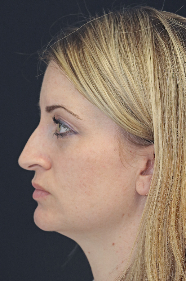 Nose Job Before And After Profile