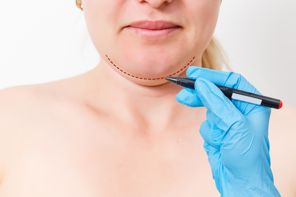 Double Chin Reduction Done the Right Way with Nashville AirSculpt