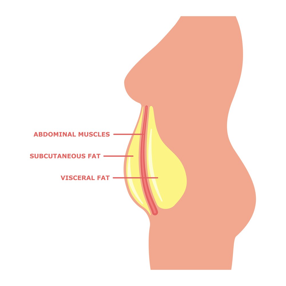 Visceral Fat Vs Subcutaneous Fat Will Lipo Help Either Visceral Fat Vs Subcutaneous Fat Will Lipo Help Either