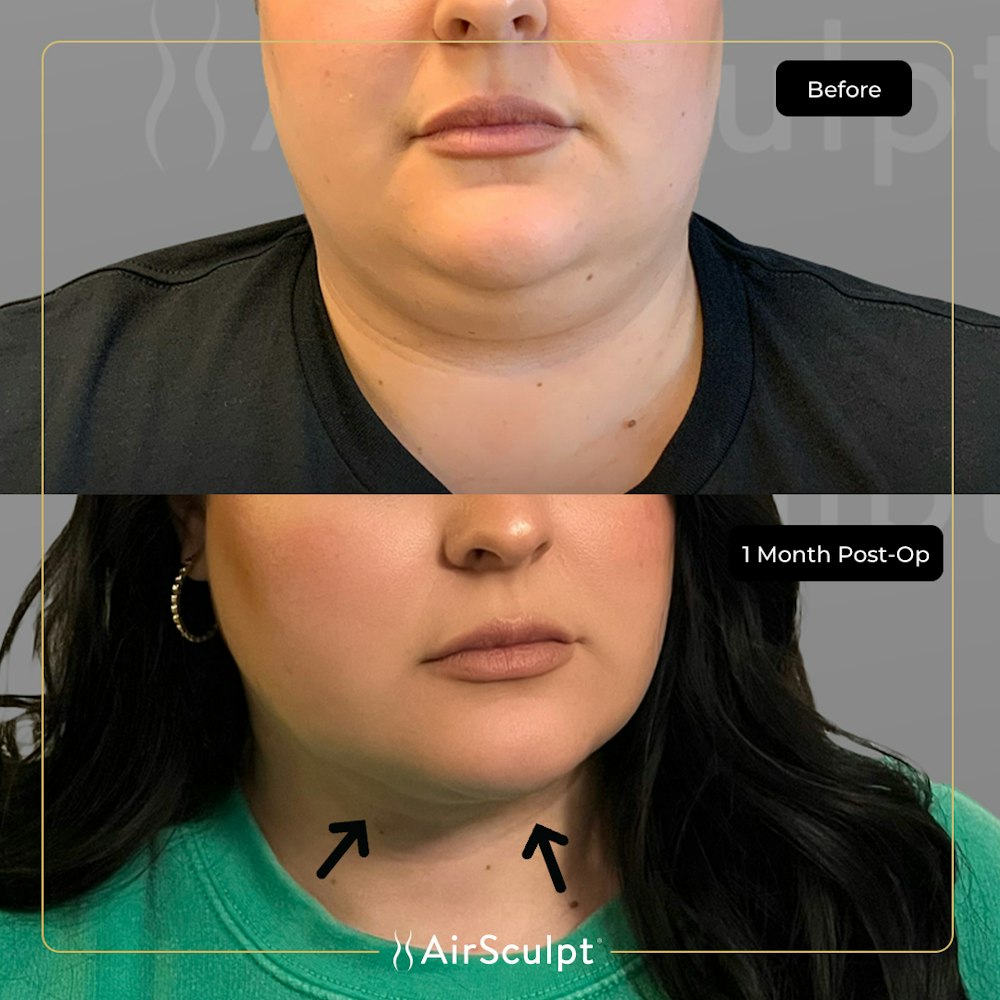 See What Double Chin Removal With AirSculpt® Achieved in Just One Month ...
