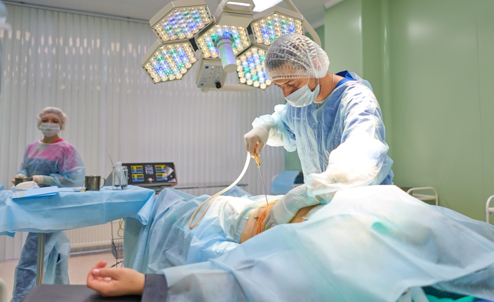 Reviewing the History of Liposuction and Cosmetic Fat Removal