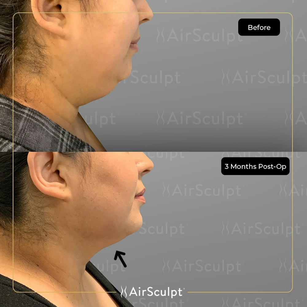 An Instant Reduction of Double Chin Fat With Tighter Skin: See This ...