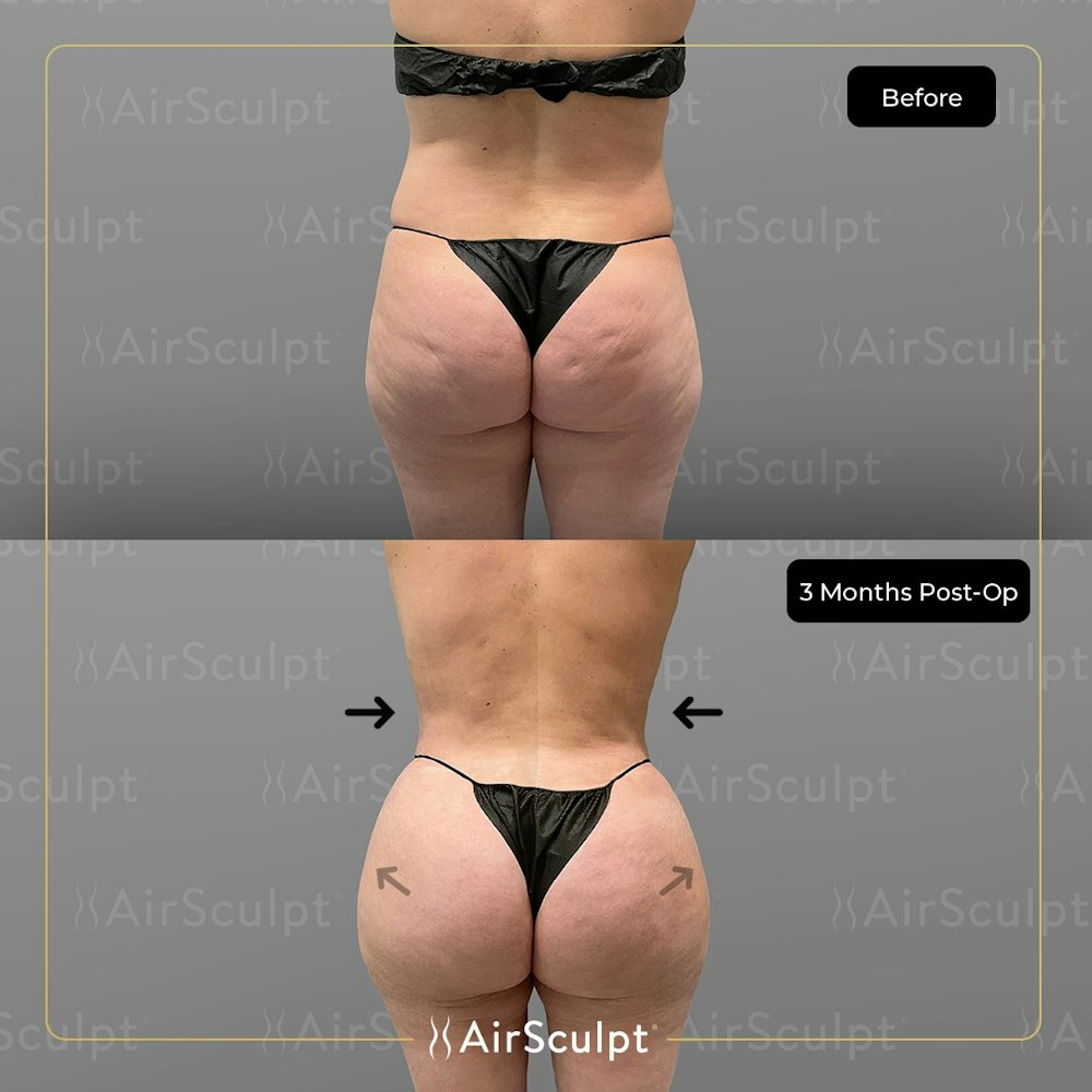 BBL vs. Butt Lift: How They Differ | AirSculpt