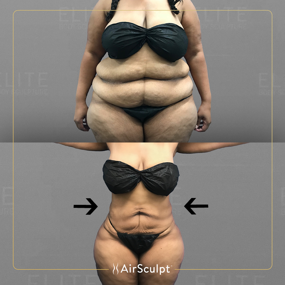 Large Volume Liposuction: How Much Fat Can Be Removed? | AirSculpt