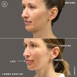 AirSculpt® Lift | Fat Transfer to the Face