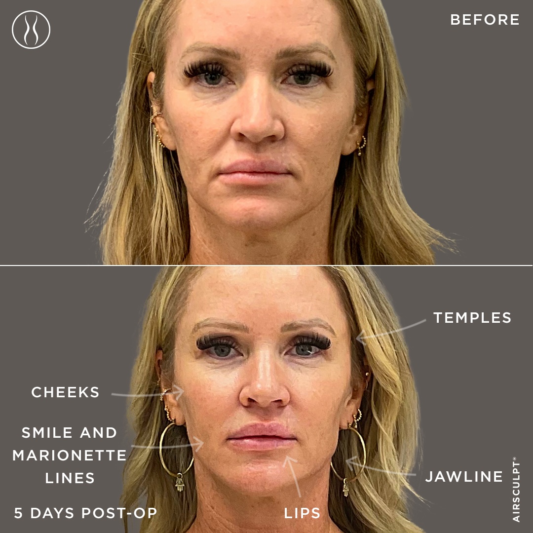 Achieving Fuller Lips The Ultimate Guide to Lip Augmentation